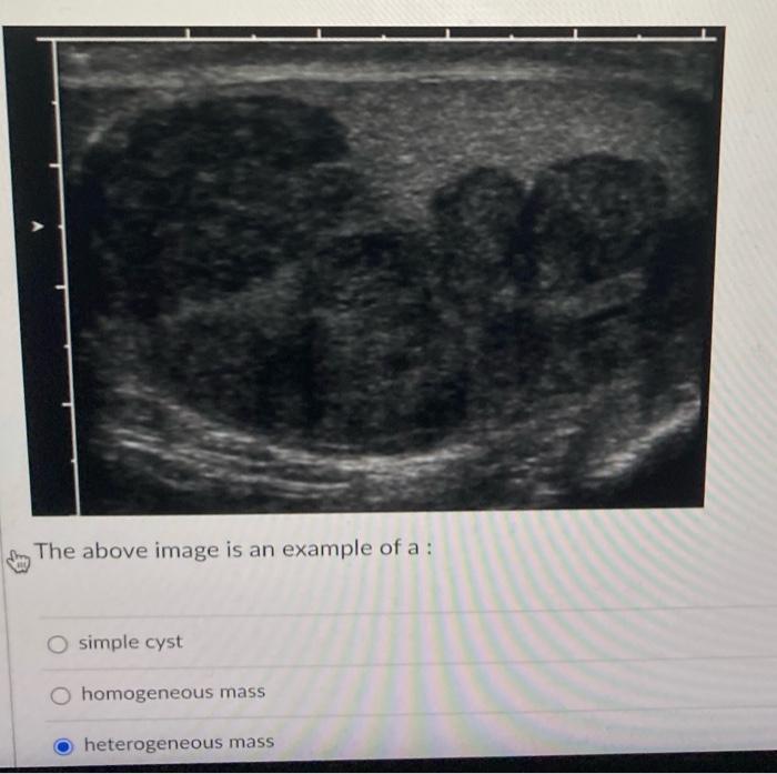 Solved The above image is an example of a : simple cyst | Chegg.com