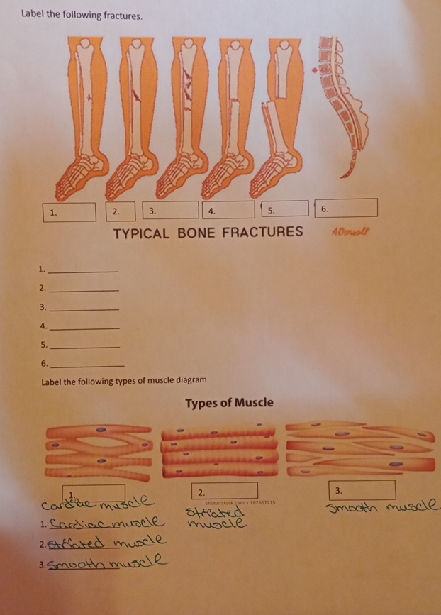 Solved Label the following fractures.2.3.4.5.TYPICAL BONE | Chegg.com