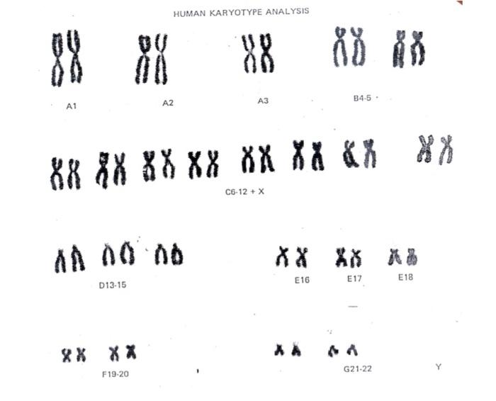 Solved HUMAN KARYOTYPE ANALYSIS 88 og 88 A1 A2 A3 B4-5 : 8ጸ | Chegg.com