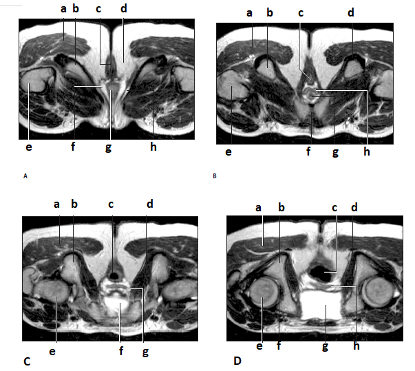 Solved Whats abnormality seen on the MRI, and label all | Chegg.com