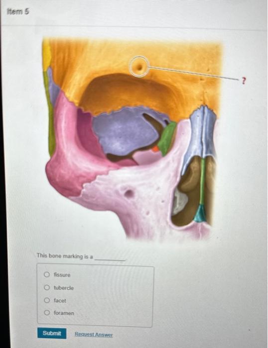 Solved This bone marking is a fissure tubercie facet: | Chegg.com
