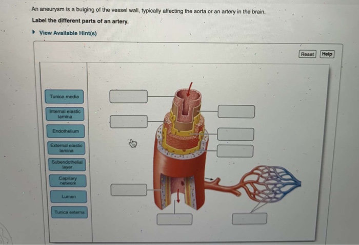 Solved An aneurysm is a bulging of the vessel wall, | Chegg.com