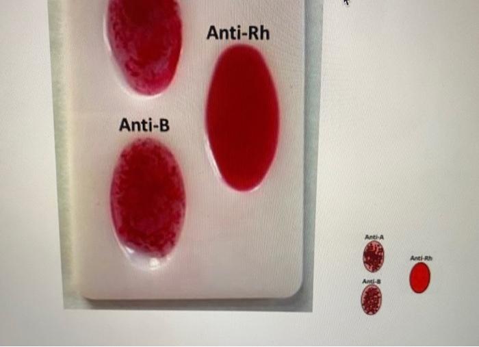 Solved this image depicts a blood typing test. a drop of | Chegg.com