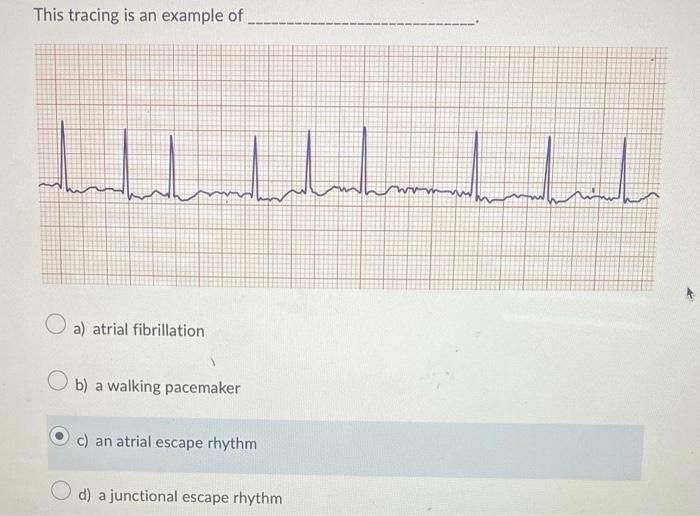 Solved This tracing is an example of a) atrial fibrillation | Chegg.com