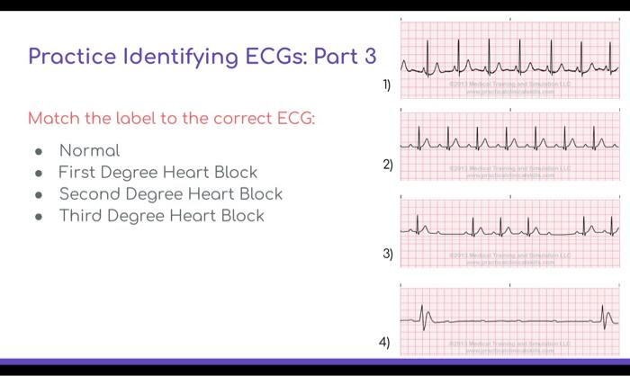 Solved Practice Identifying ECGs: Part 3 Match the label to | Chegg.com