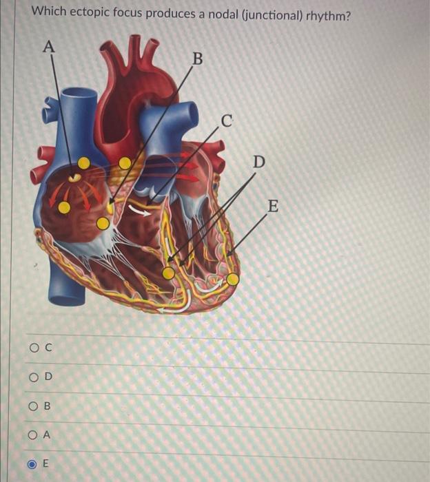 Solved Which ectopic focus produces a nodal (junctional) | Chegg.com