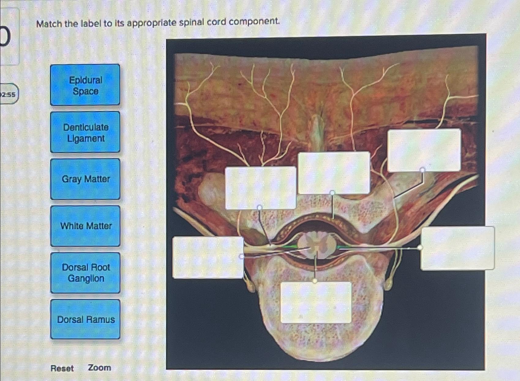 Solved Match the label to its appropriate spinal cord | Chegg.com