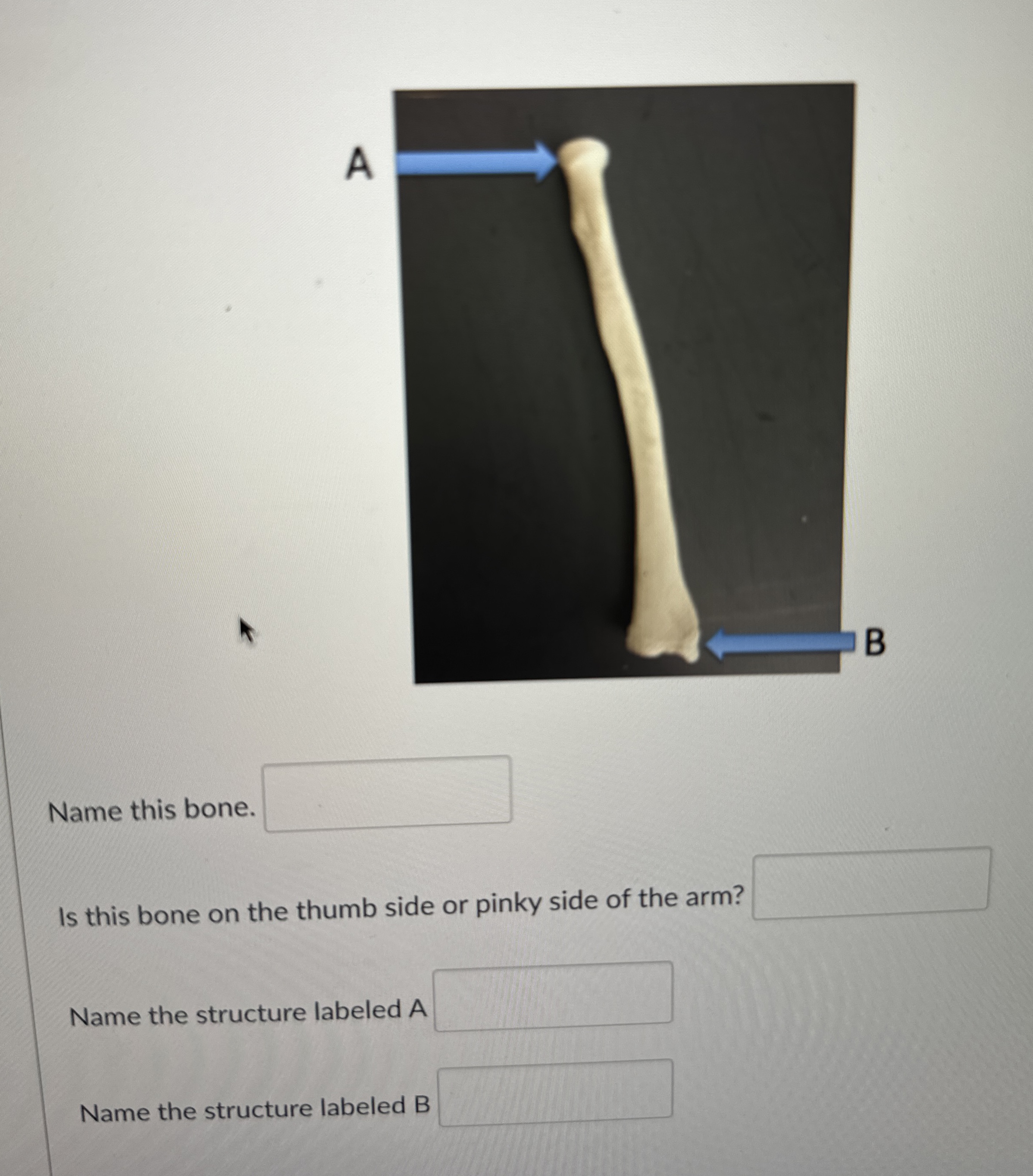 Name this bone.Is this bone on the thumb side or | Chegg.com