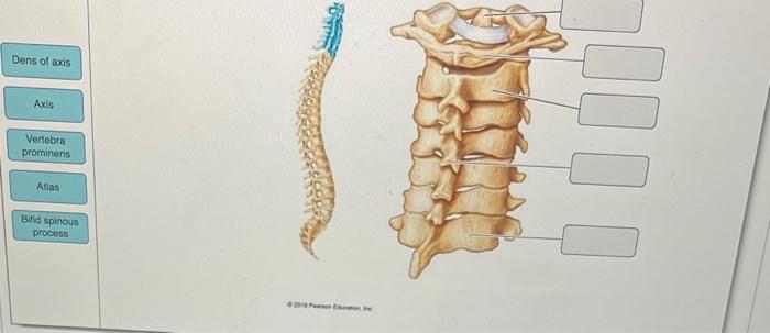 Solved Dens of axis Axis Vertobra prominens Alias Bifid | Chegg.com
