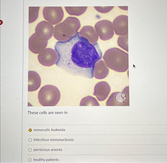 Solved 2 These cells are seen in O monocytic leukemia O | Chegg.com