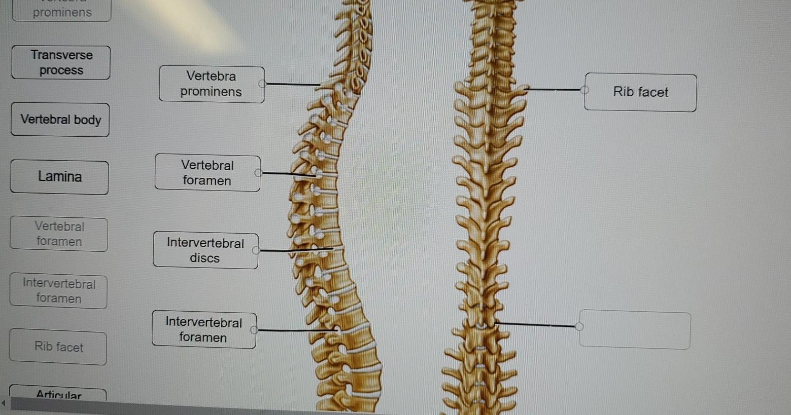 Solved prominens Transverse process Vertebra prominens Rib | Chegg.com
