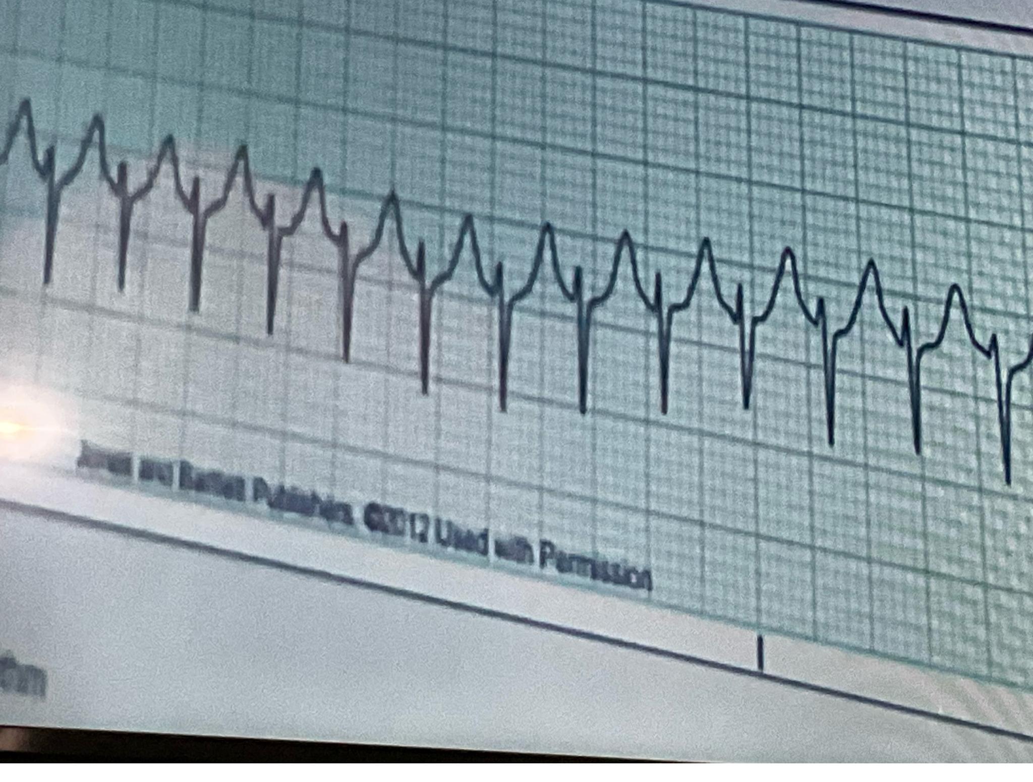 Solved What is this cardiac rhythm ? ﻿Sinus Tachycardia SVT | Chegg.com