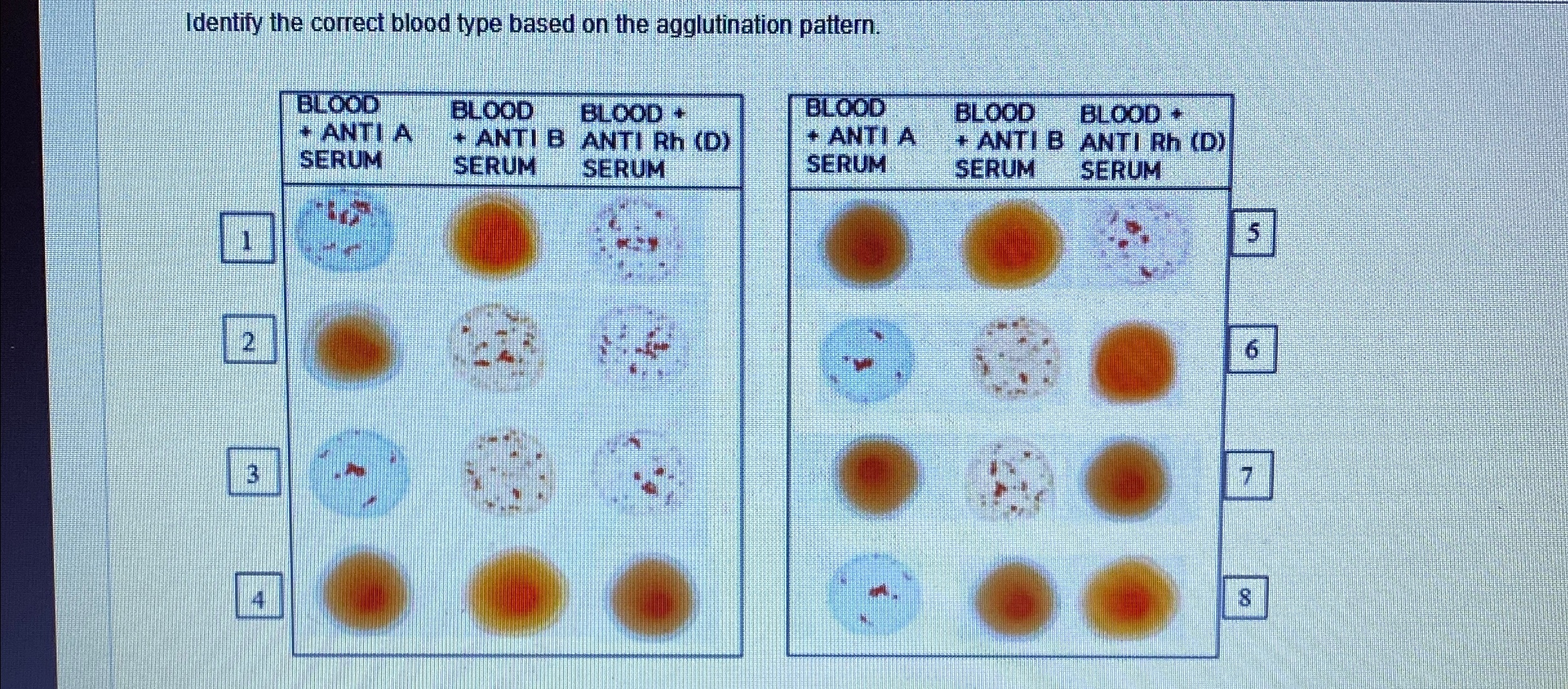 Solved Identify the correct blood type based on the | Chegg.com