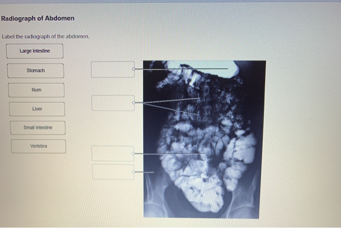Solved Radiograph of Abdomen Label the radiograph of the | Chegg.com