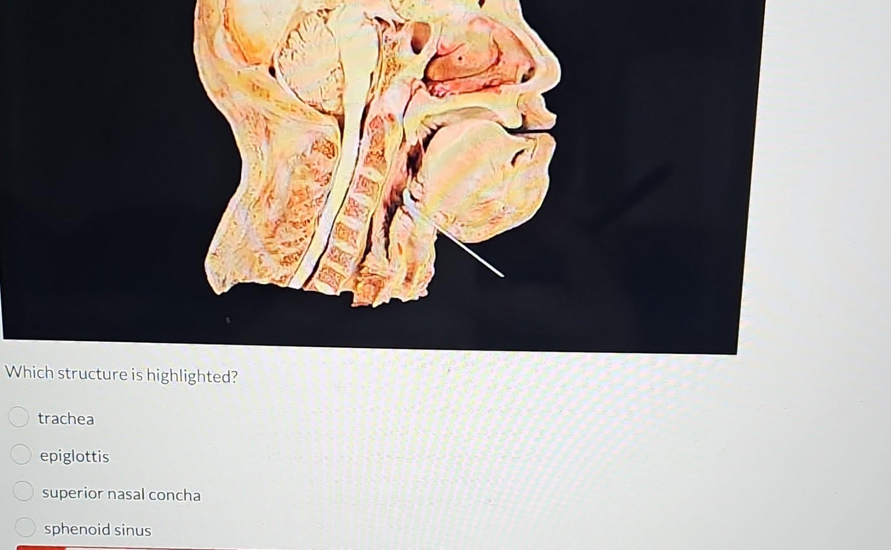 [Solved]: Which structure is highlighted? trachea epigl