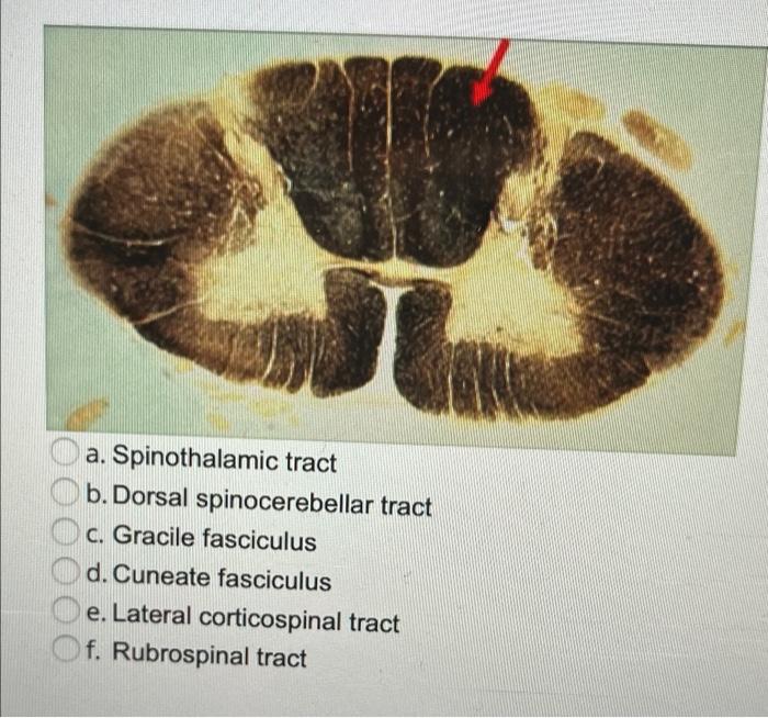 Solved a. Spinothalamic tract b. Dorsal spinocerebellar | Chegg.com