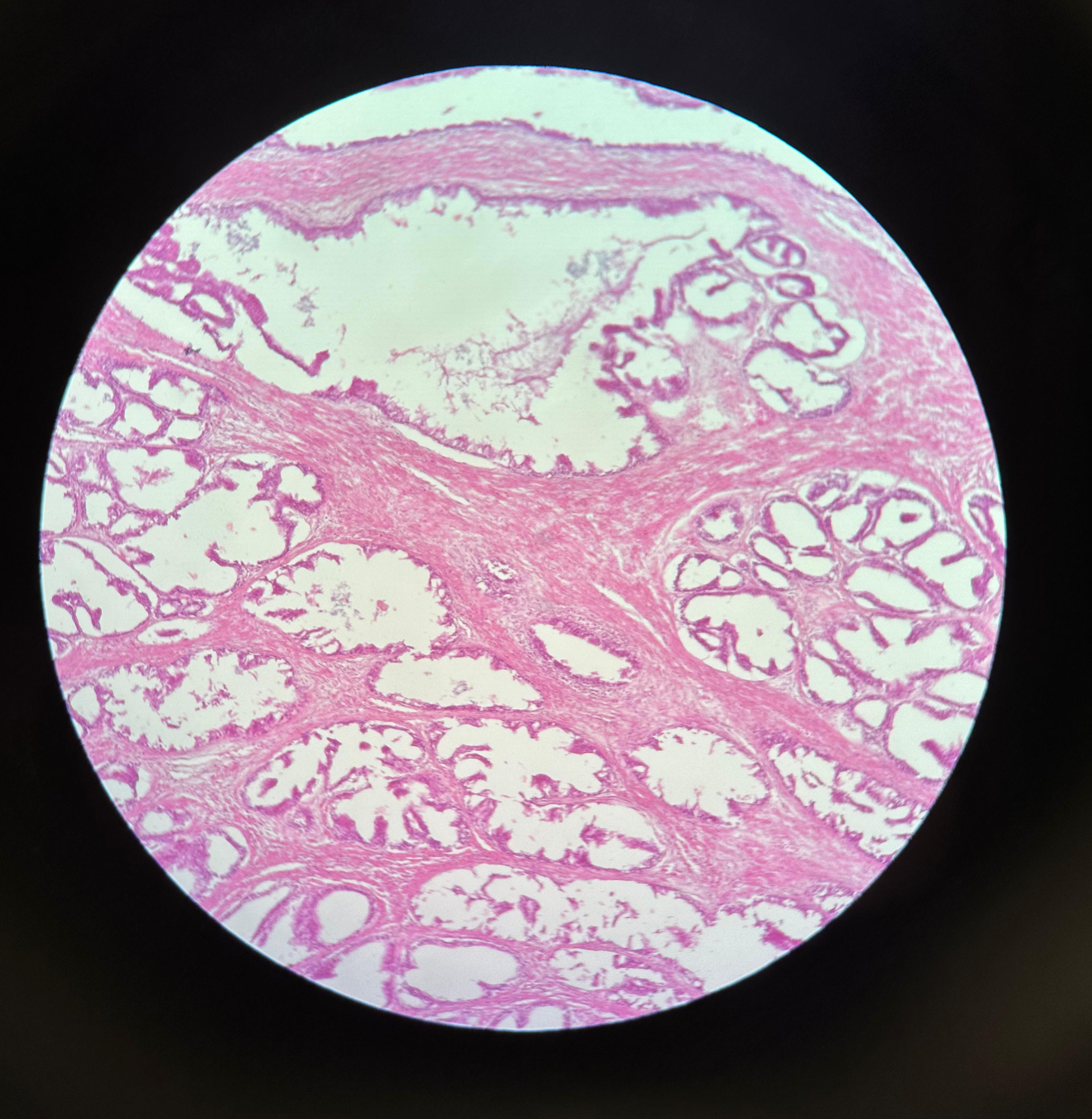 Solved Pathologic change: Benign hyperplasia prostate1. | Chegg.com