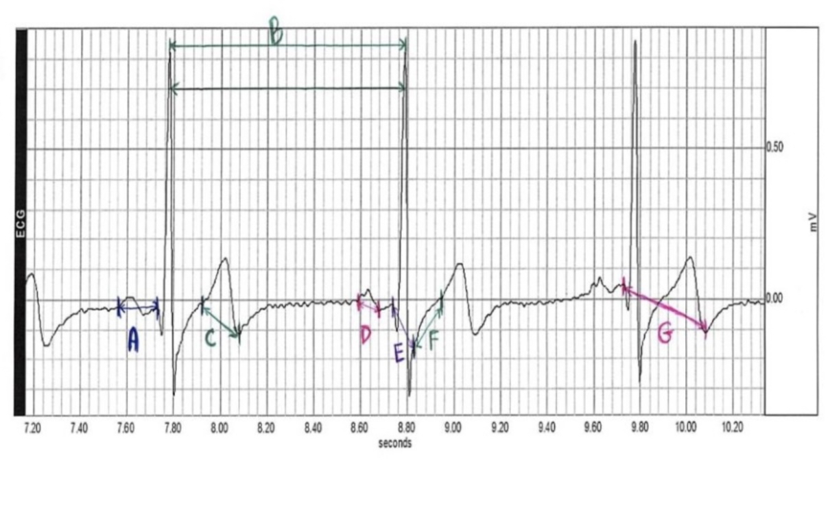 a) ﻿what is the peak amplitude or the T wave? | Chegg.com