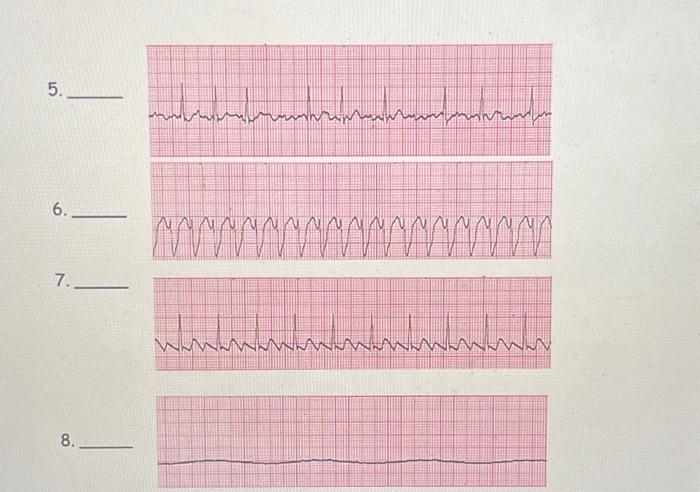 Solved Match the heart condition with EKG strip A Asystole | Chegg.com