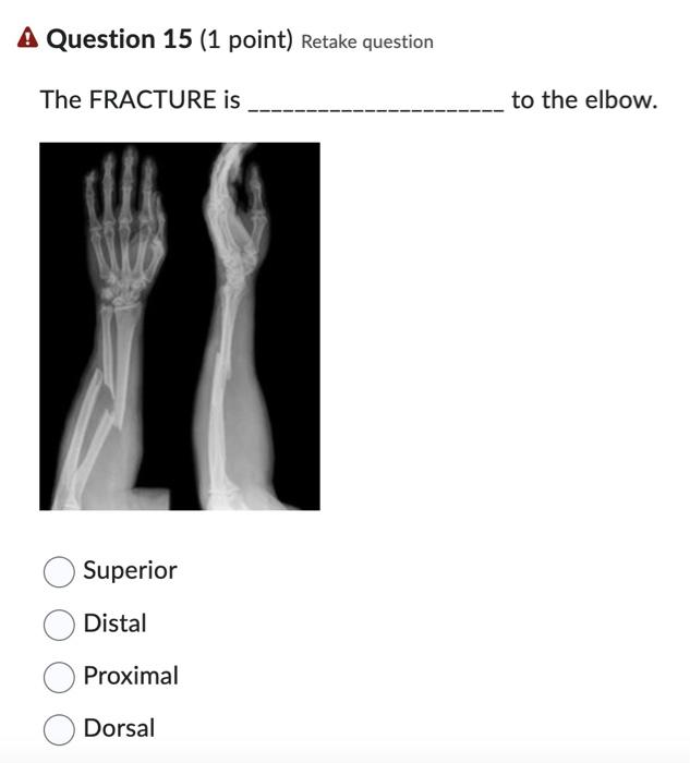 Solved Question 15 (1 point) Retake question The FRACTURE is | Chegg.com Solved Question 15 (1 point) Retake question The FRACTURE is | Chegg.com