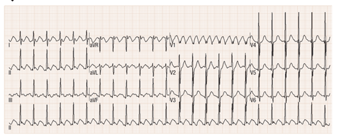 Atrial rate:Ventricular rate:AV conduction | Chegg.com