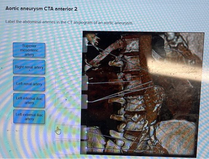 Solved Label the abdominal arteries in the CT angiogram of | Chegg.com