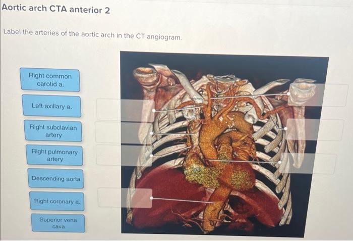 Solved aortic arch CTA anterior 2label the arteries of the | Chegg.com