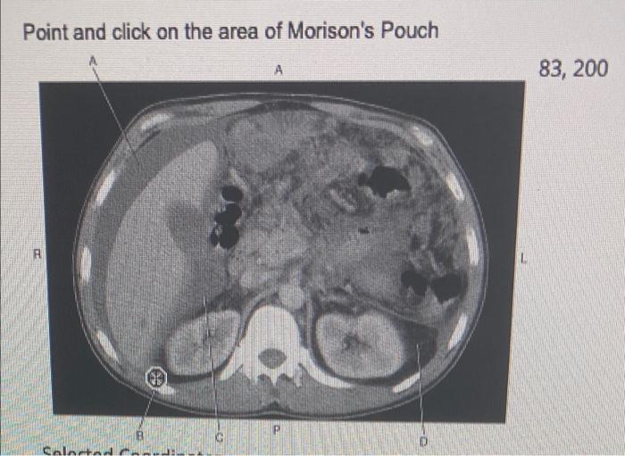 Solved QUESTION 14 Point and click on the right hepatic vein | Chegg.com