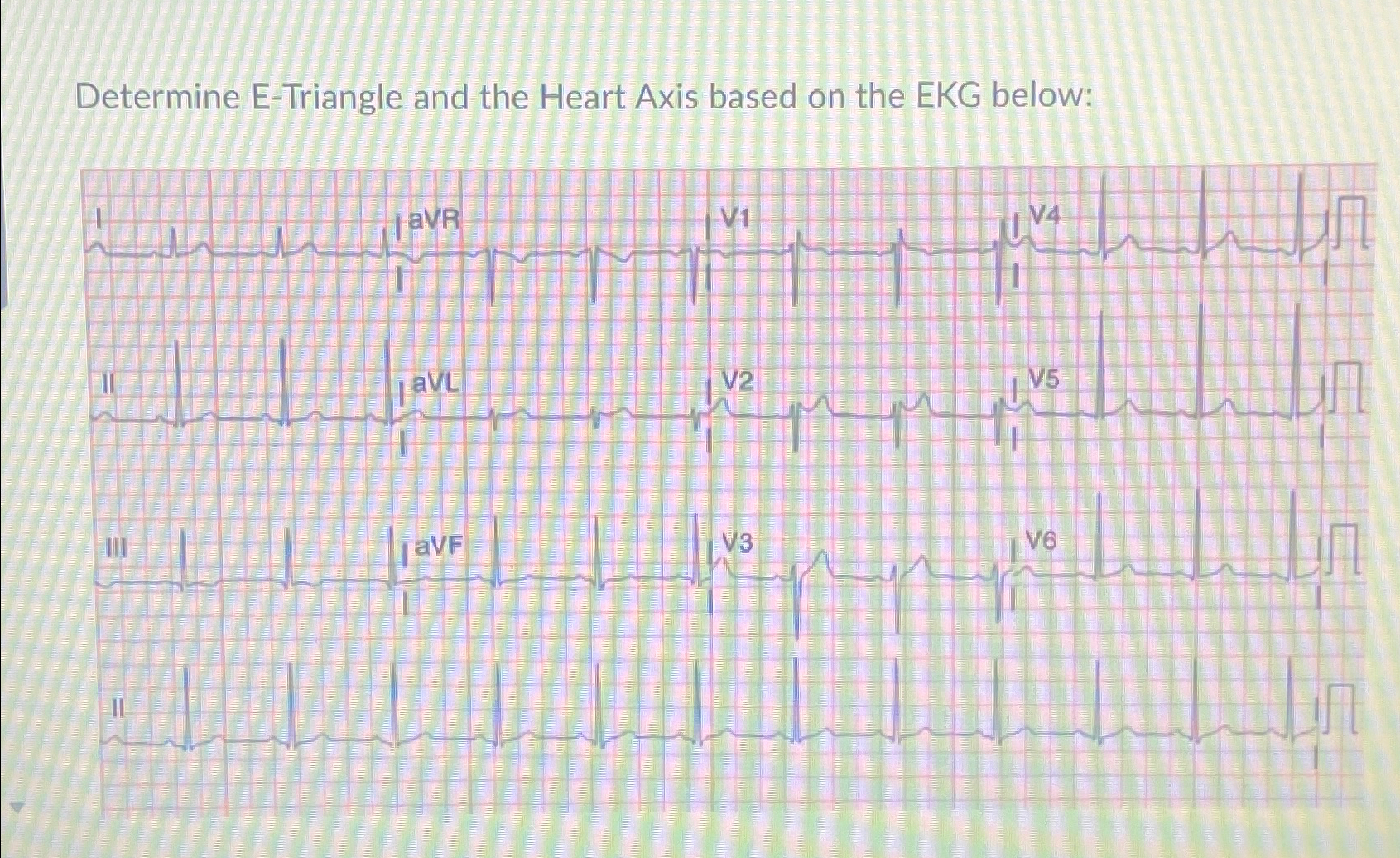 Solved Determine E-Triangle and the Heart Axis based on the | Chegg.com