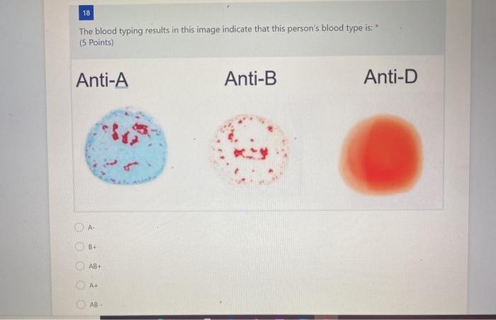 Solved 18 The blood typing results in this image indicate | Chegg.com