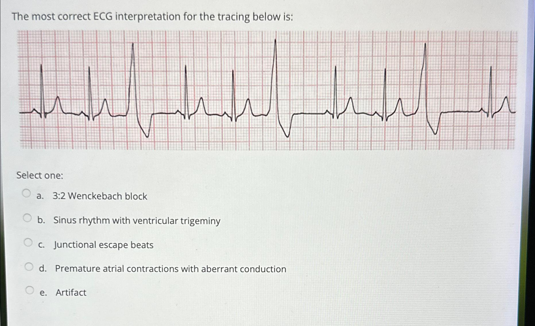 Solved The most correct ECG interpretation for the tracing | Chegg.com