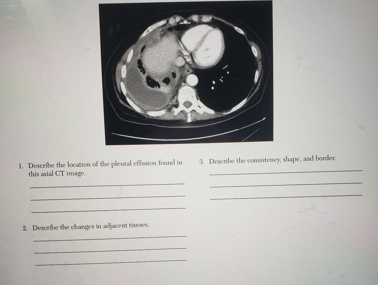 Solved Describe the location of the pleural effusion found | Chegg.com