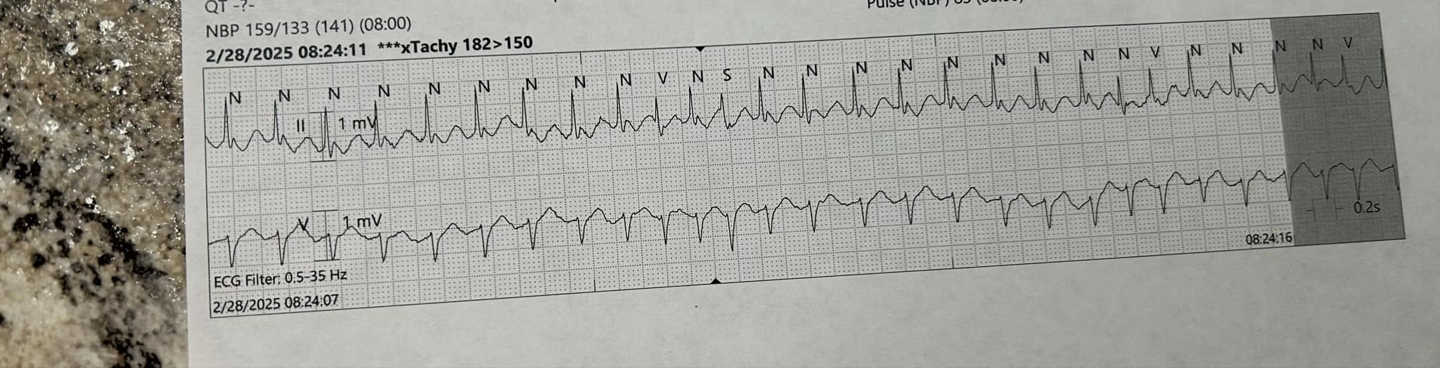 Solved Answer for strips 1-5. ﻿What is the PR interval? QRS? | Chegg.com