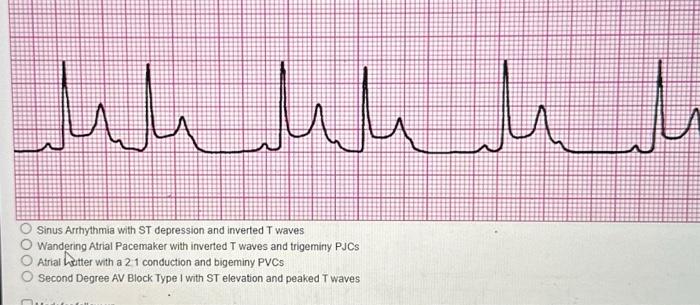 Solved Sinus Arrhythmia with ST depression and inverted T | Chegg.com