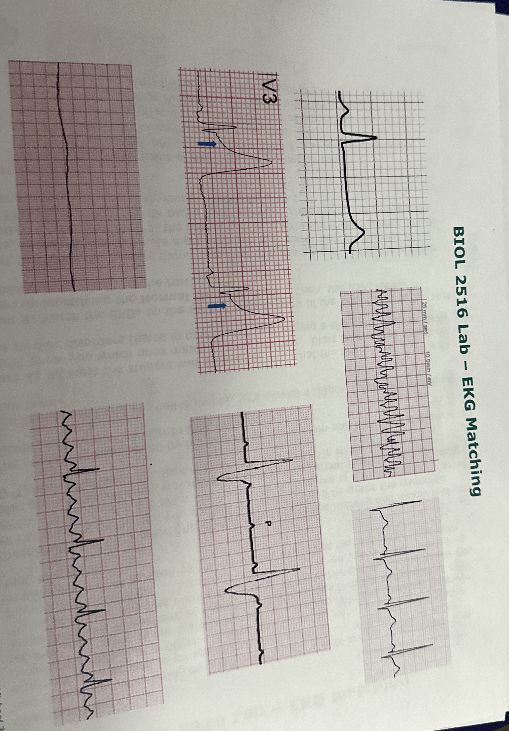 Solved EKG MatchiNh: Matxh these 7 ﻿EKGs from the following | Chegg.com