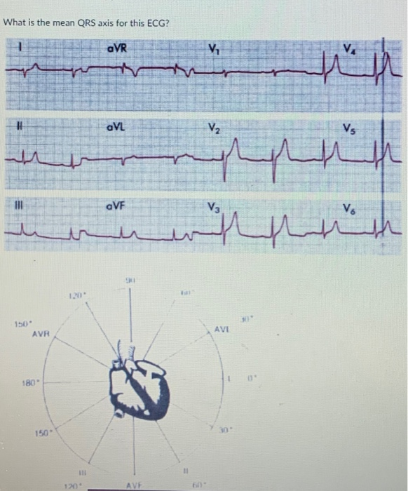 Solved What is the mean QRS axis for this ECG? AVR V V " H | Chegg.com