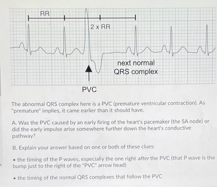 Solved RR H 2 x RR un mm next normal QRS complex PVC The | Chegg.com