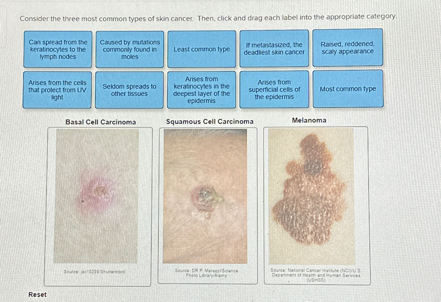 Solved Consider the three most common types of skin cancer. | Chegg.com