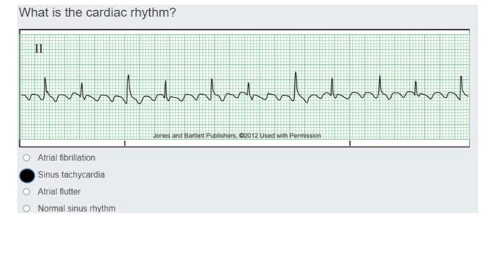 Solved What is the cardiac rhythm? | Chegg.com