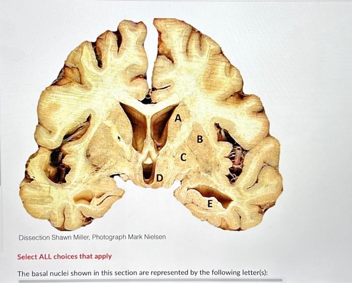 Solved Select ALL choices that apply The basal nuclei shown | Chegg.com Solved Select ALL choices that apply The basal nuclei shown | Chegg.com
