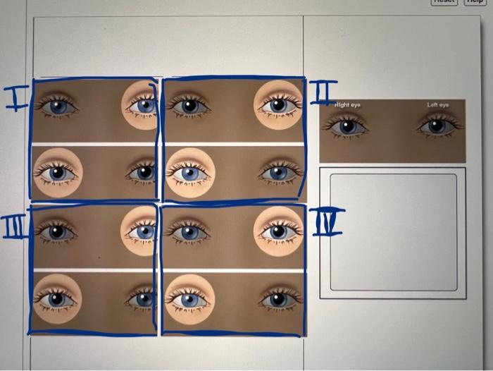 Solved Clinicians can use pupillary reflexes to distinguish | Chegg.com
