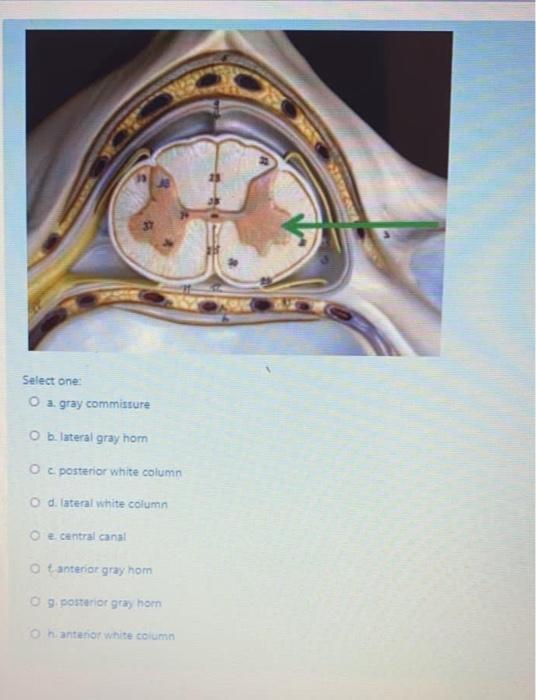 Solved Select one: O a gray commissure O bilateral gray hom | Chegg.com