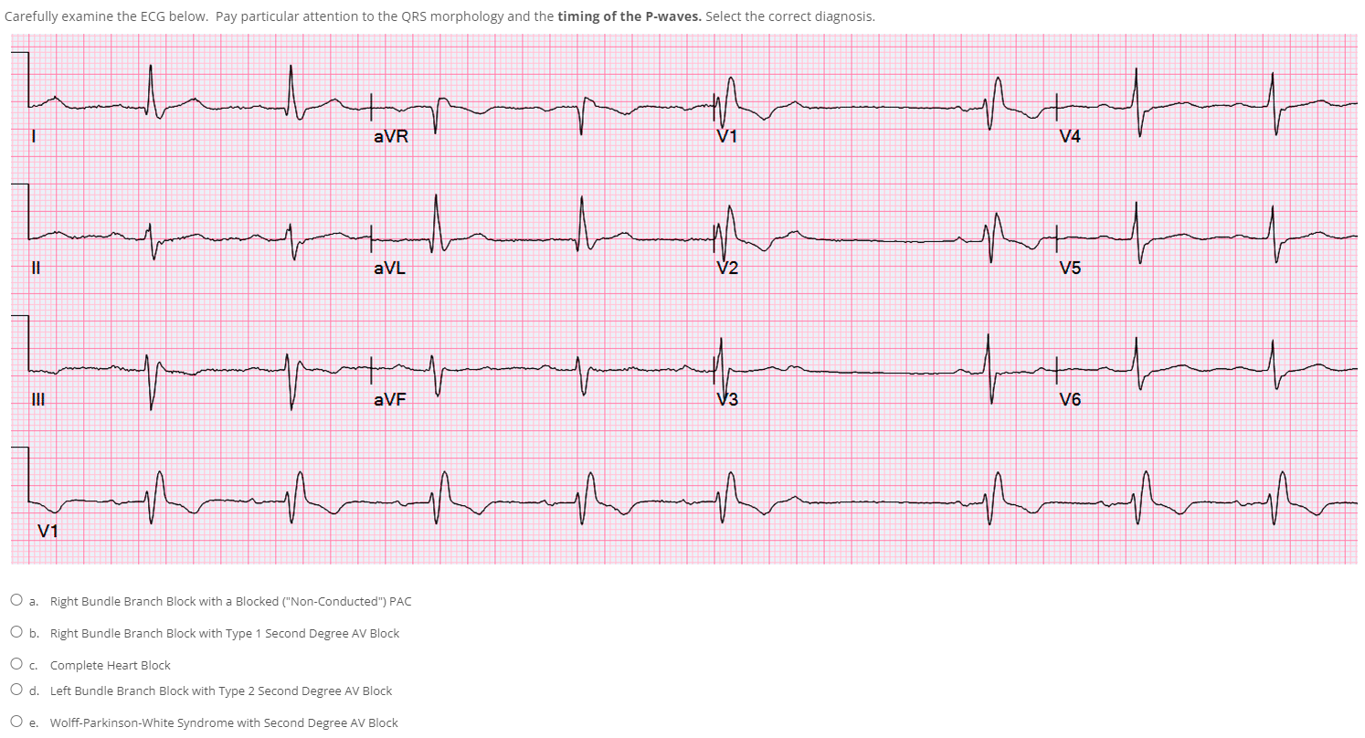 Solved Carefully examine the ECG below. Pay particular | Chegg.com