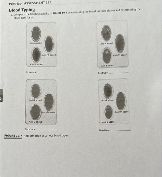 Solved Blood Typing 1. Complete the labeling activity in | Chegg.com