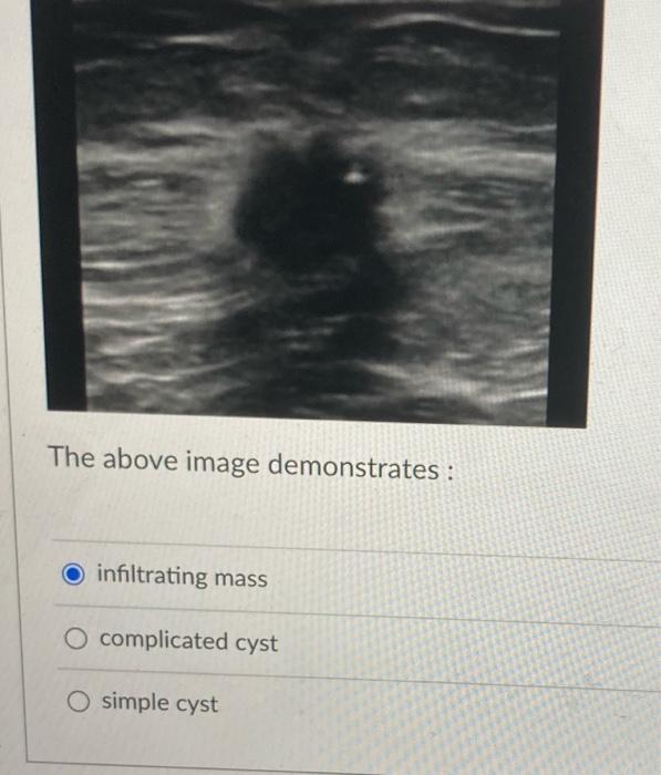Solved The above image is an example of a : simple cyst | Chegg.com