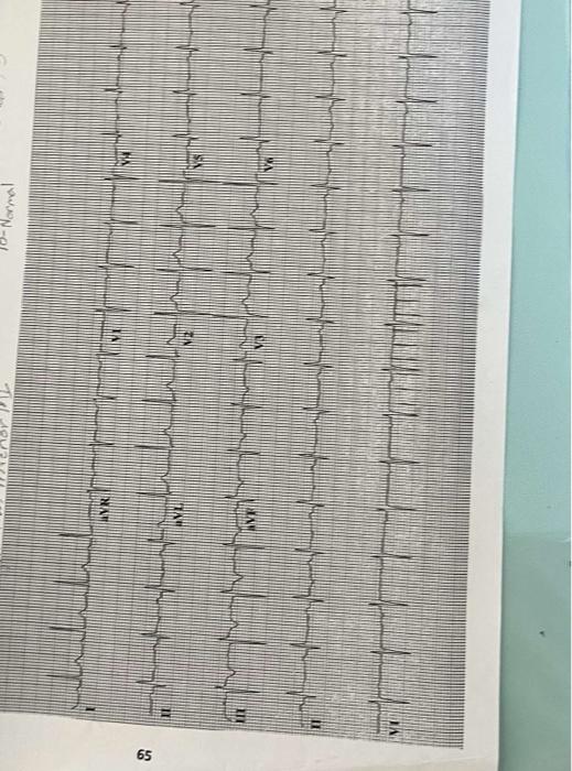 Solved name/interpretation for 12 lead EKG | Chegg.com