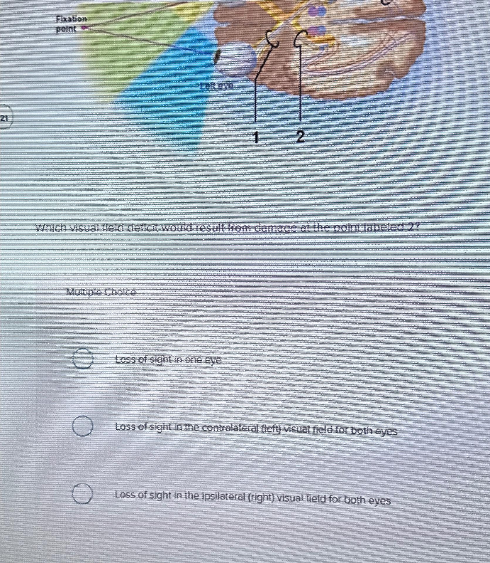 Solved Which visual field deficit would result from damage | Chegg.com