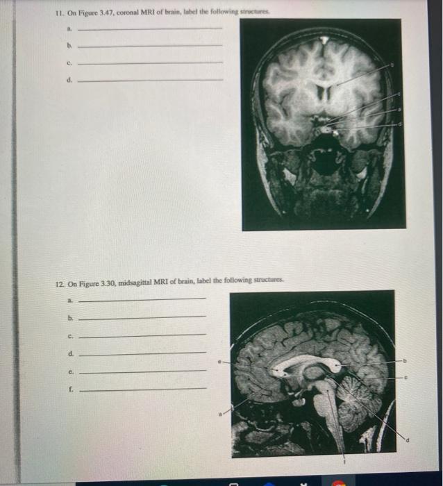 Solved 11. On Figure 347, coronal MRI of brain, label the | Chegg.com
