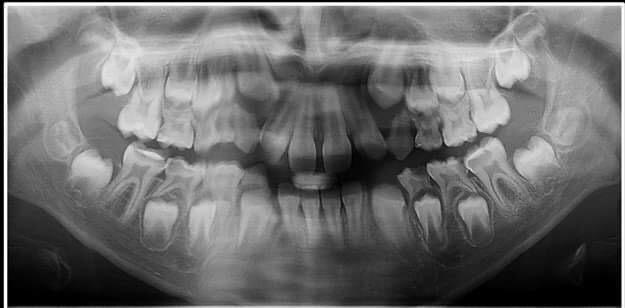 Solved classify these tooth in carries radiographic | Chegg.com