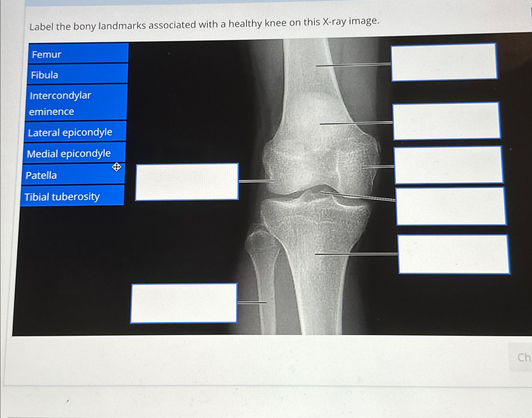 Solved Label the bony landmarks associated with a healthy | Chegg.com